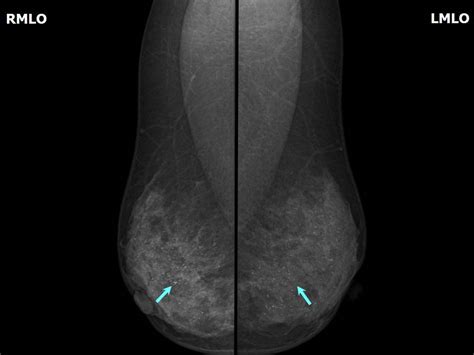 Atlas Of Breast Cancer Early Detection