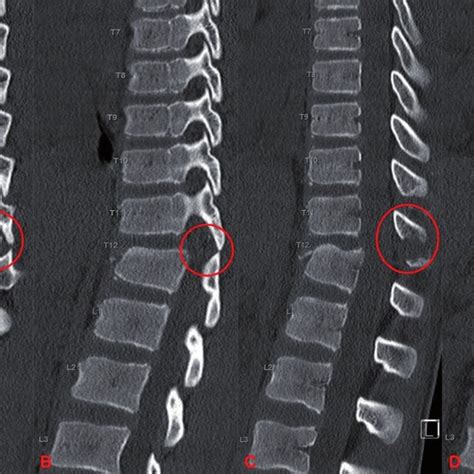 Case 4 Preoperative Ct Showing C5 C6 Facet Fracture Dislocation And Download Scientific