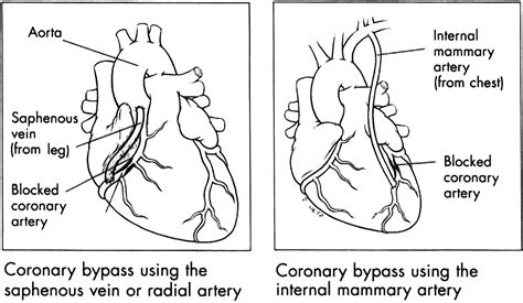 Coronary Bypass Pump Cardiopulmonary Bypass Procedure Uses And More