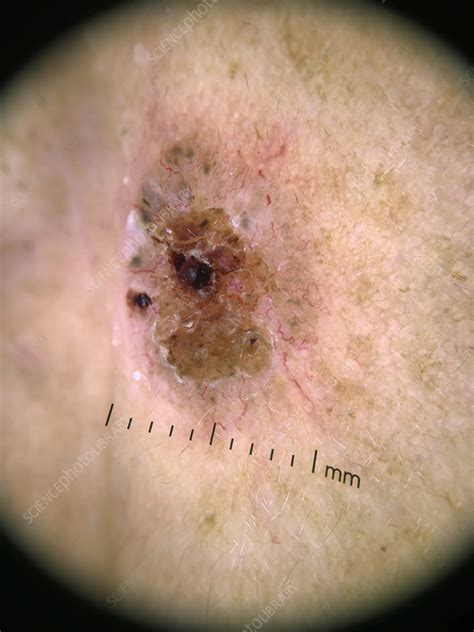 Nodular Basal Cell Carcinoma Stock Image C056 3116 Science Photo Library