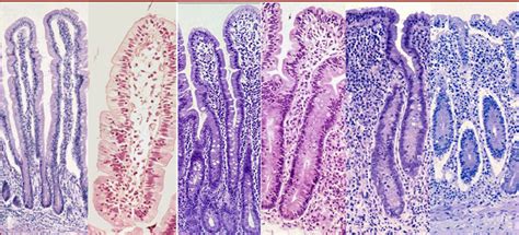 Marsh Scores Trusted Resource For Celiac Disease