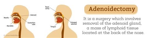 Adenoidectomy Indications Preparation Procedure And Complications