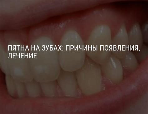 Пятна на зубах белые желтые коричневые черные причины и лечение