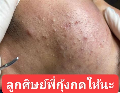 สิวอุดตัน‼️‼️ พี่กุ้งกดสิว มาดามกิ๊กกี้ สาขาสาธุประดิษฐ์