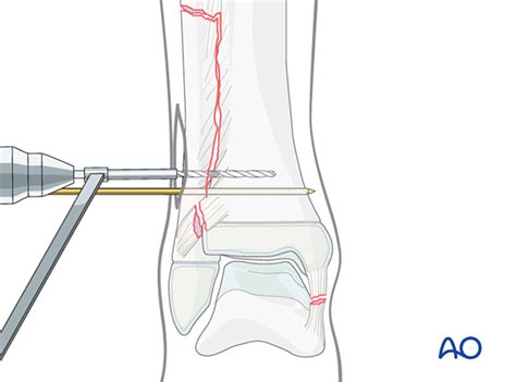 Syndesmotic Transfixation With Screws For Syndesmotic Injuries