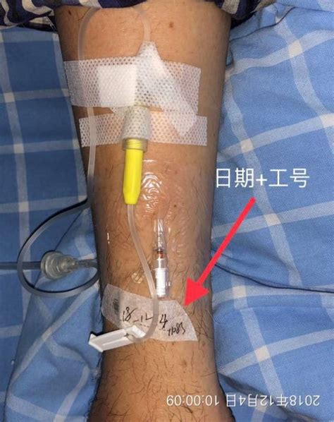 留置针固定 留置针u型固定图片 留置针正确固定图片 第7页 大山谷图库