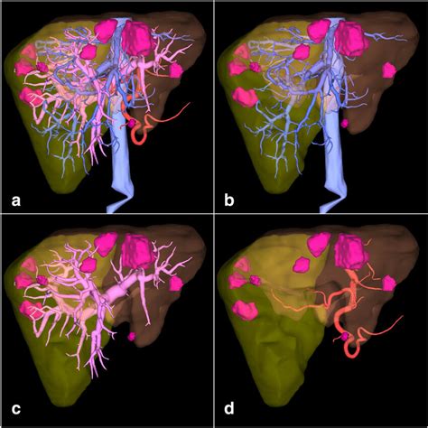 A Anterior View Of 3d Volume Rendering Images Showing Virtual Download Scientific Diagram