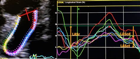 Atrial Segmentation For Longitudinal Strain Quantification Using 2d