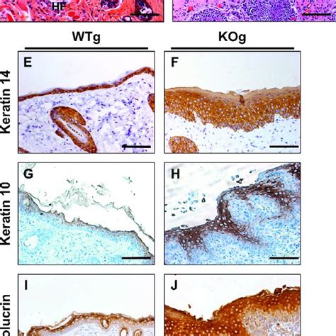 Ichthyosiform Phenotype Abnormal Differentiation And Asymmetrical