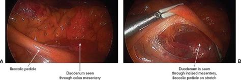 Laparoscopic Partial Colectomy Basicmedical Key