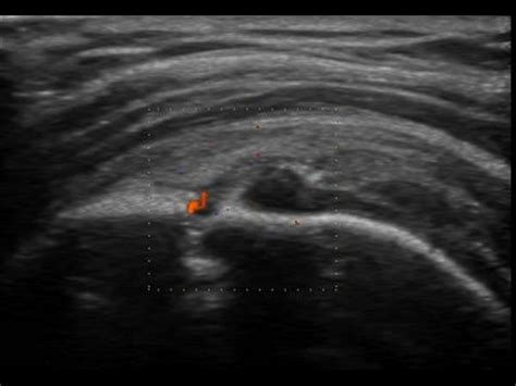 Musculoskeletal Joints And Tendons 61 Shoulder Case 615 Rotator