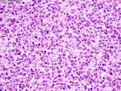 How Do Malignant Gists Metastasize And What Are The Implications For Treatment Expert Cancer