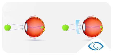 Astigmatismo Dr Pedro Oliveira® Ocularis Clinic