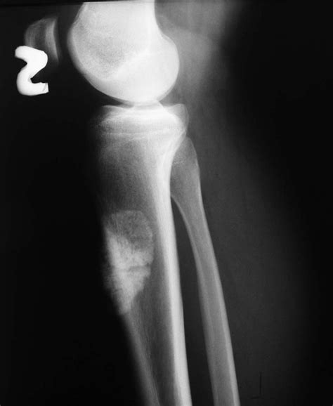 10 Adult Tibia Mass