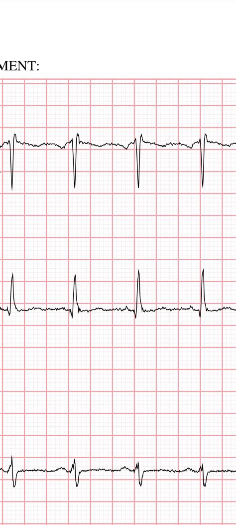 Is It Possible For A Pvc To Immediately Follow A Pac R Ecg