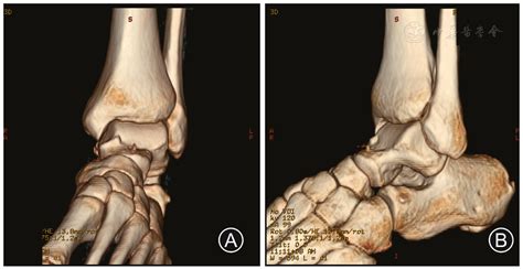 Tibiotalar Joint Dislocation