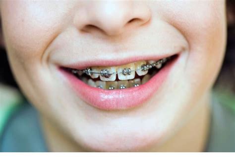The First Time With Your Braces What To Expect