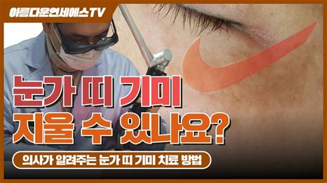 【의사가 알려주는】 눈가 띠기미나이키형 기미 치료가 되나요 기미없애는법 기미레이저 흑자없애는법 【대전세종청주천안공주유성】 피부과 Youtube