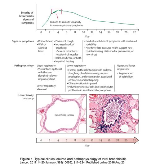 Acute Bronchiolitis