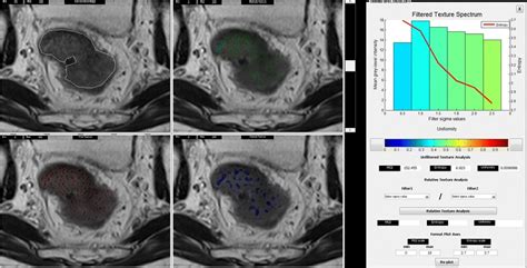 Texture Analysis Of A T2 Weighted Mri Image Of Rectal Cancer Download