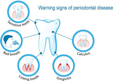 Dental Prevention Periodontal Disease At Kaitlyn Corkill Blog