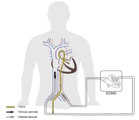 Pink Fluid Coming Up The Tube Ecmo Lv Distention And More Intensive