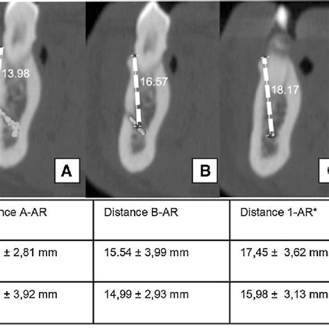 Pdf Anterior Loop Of The Mental Nerve Mental Foramen And Incisive Nerve Emergency