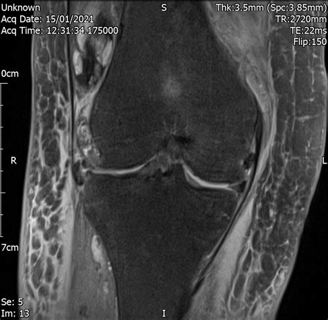 Knee Synovitis Cases Home