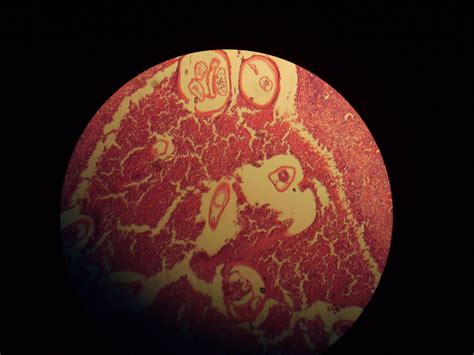 Onchocerciasis Doccheck