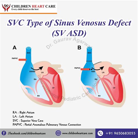 Sinus Venosus Asd