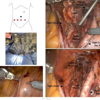 Surgical Procedure A Port Placement Accessory Port At Left Upper Download Scientific