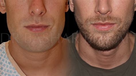 Did Disha Patani Undergo Cosmetic Surgery Rumours Sparked By Viral