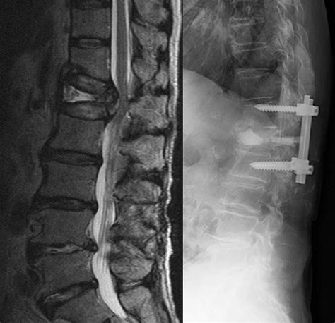 An 86 Year Old Female Patient Who Underwent Posterior Decompression And