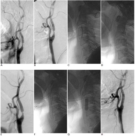 경동맥 협착증은 무엇이며 원인과 진단 그리고 치료방법을 알아봅니다