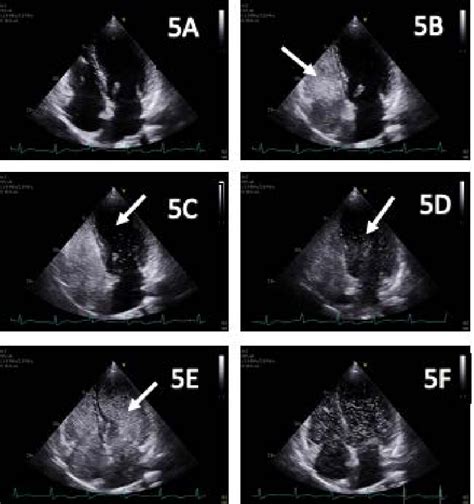 60 Year Old Lady With Hepatopulmonary Syndrome Download Scientific