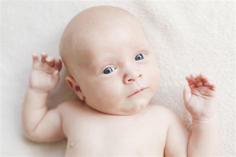 Torticollis Congenital Wry Neck Physiotherapy News