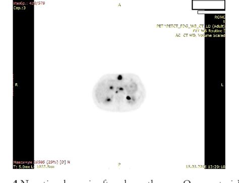 Table 1 From Personalised Approach In Combined Treatment Of Cholangiocarcinoma A Case Report Of
