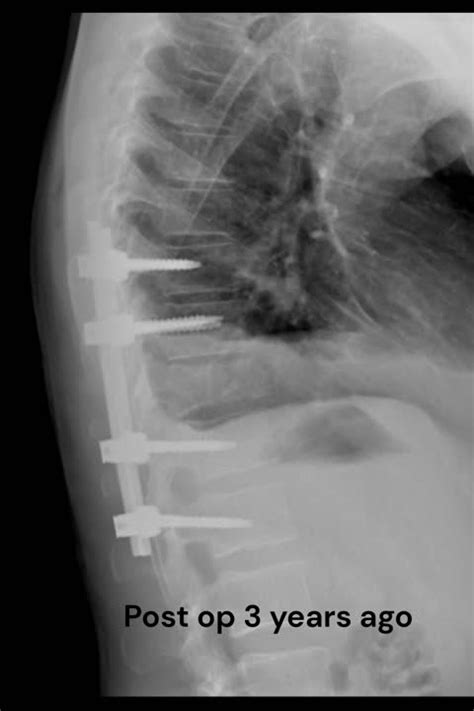 Pier Francesco Cappai On Linkedin Spine Neurosurgery Orthopedics Pseudoarthrosis 15 Comments