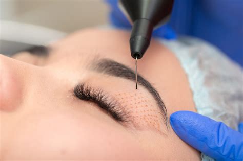 Non Surgical Eyelid Lift Skin Muse Md