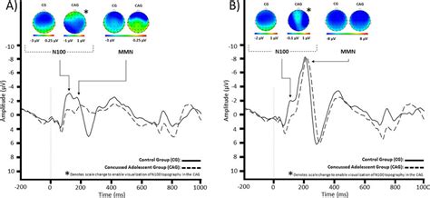 Grand Averaged Mmn Protocol Waveforms And Their Respective Scalp
