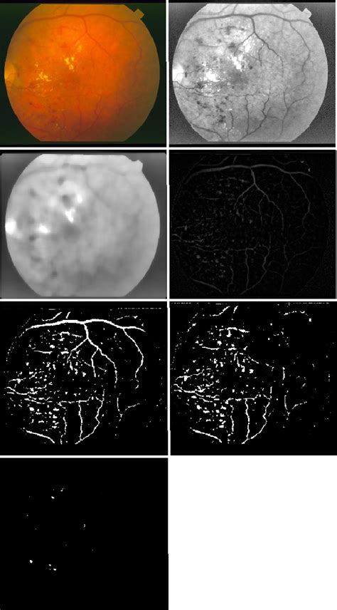 Diabetic Retinopathy Detection In Digital Fundus Images Retinaclassifier