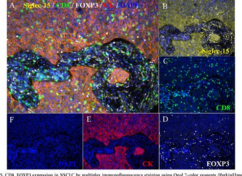 Figure 1 From The Significance Of Siglec 15 Expression In Resectable Non Small Cell Lung Cancer