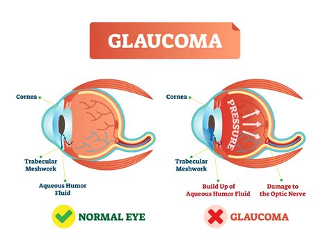 Differential Diagnosis Glaucoma And Cataracts Nursing Ce Central