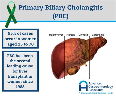Primary Biliary Cholangitis What It Is Symptoms 48 Off