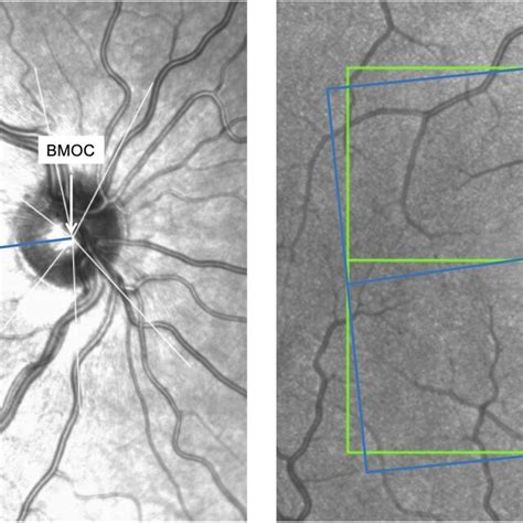 Oct A Scan Window Of Macula Region Without Green Box And After Blue Download Scientific
