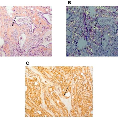 Histology Thyroid Pathologic Sample Of Patient B With Amyloid Download Scientific Diagram