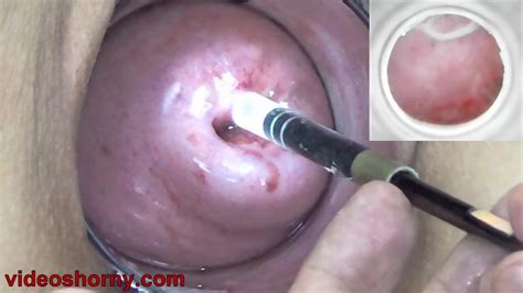 Endoscope With Camera Is Inserted Into The Cervix To See Inside