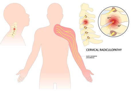 Understanding Cervical Radiculopathy Causes Symptoms And Treatment Atlantic Spine Specialists