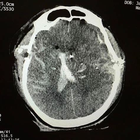Self Inflicted Gunshot Wound To The Head