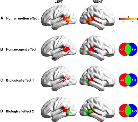 Functional Mri Results In The Lateral Temporal Lobe For Healthy